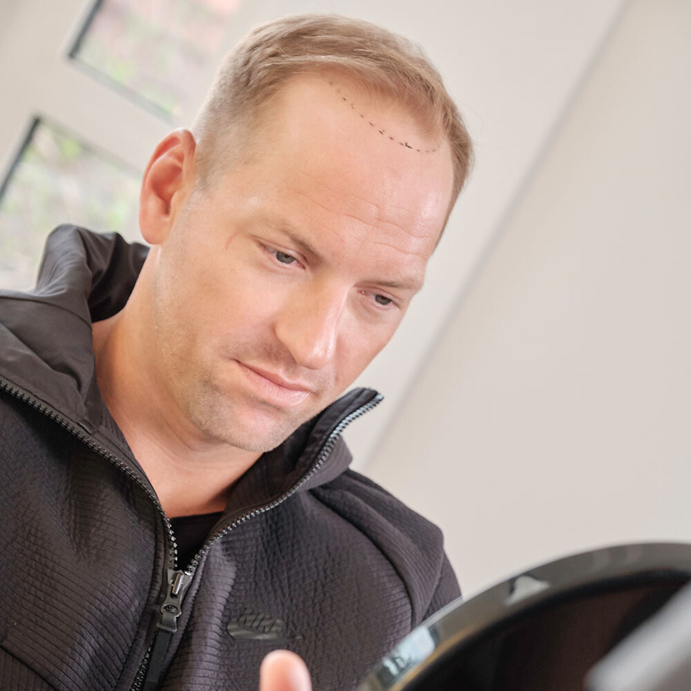 Haartransplantation von Alexander Horst | Moser Medical